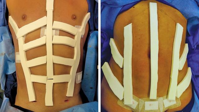 来年の夏には間に合う。お腹を人工的にシックスパックに割る手術 | ギズモード・ジャパン